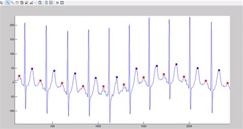 qrs complex detection result download scientific diagram