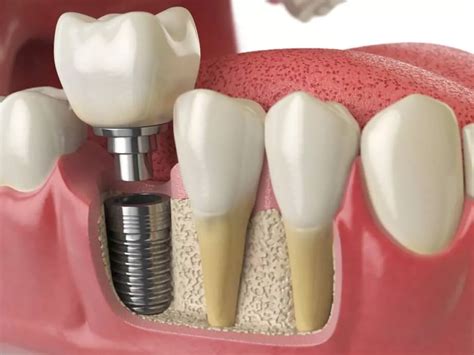 Implants Dentaires Tout Savoir Soindentaire