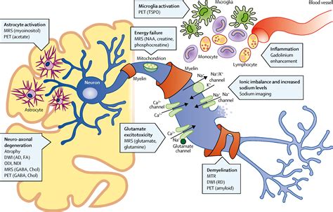 Multiple Sclerosis The Lancet