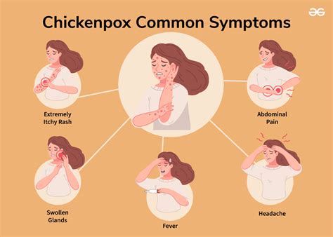 Chickenpox Symptoms Treatment Preventions And Facts GeeksforGeeks