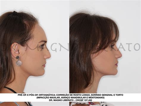 Cirurgia Ortognática Minimamente Invasiva Dr Magno Liberato