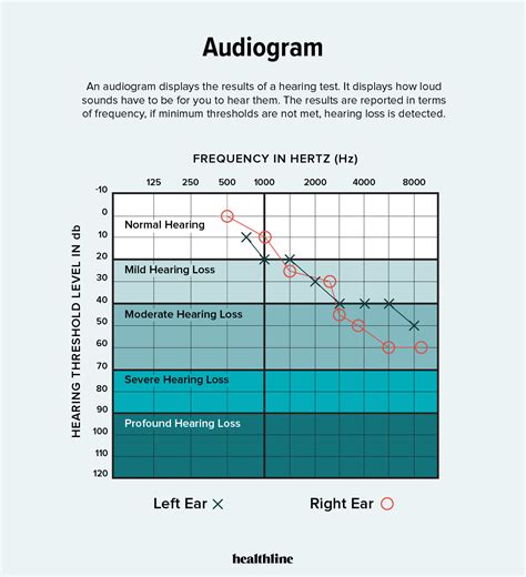 Profound Sensorineural Hearing Loss Audiogram