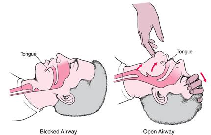 A Guide To Airway Management For First Aiders And Responders First
