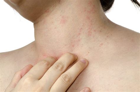 Quais são os Tipos de Dermatite de Contato