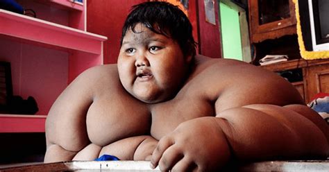 La Transformation Incroyable De Arya Permana Lenfant Le Plus Gros Au Monde