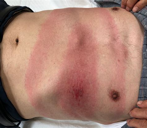 Large Erythema Migrans Lesion In Lyme Disease Takeuchi