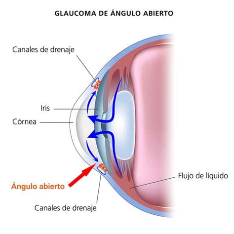 Glaucoma Visual Do