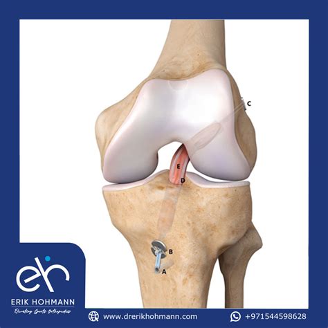 Anterior Cruciate Ligament Injuries Dr Erik Hohmann