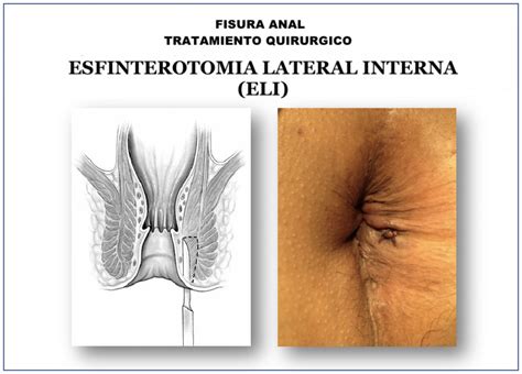 Fisura Anal Por Sexo Anal Clearance Varsana