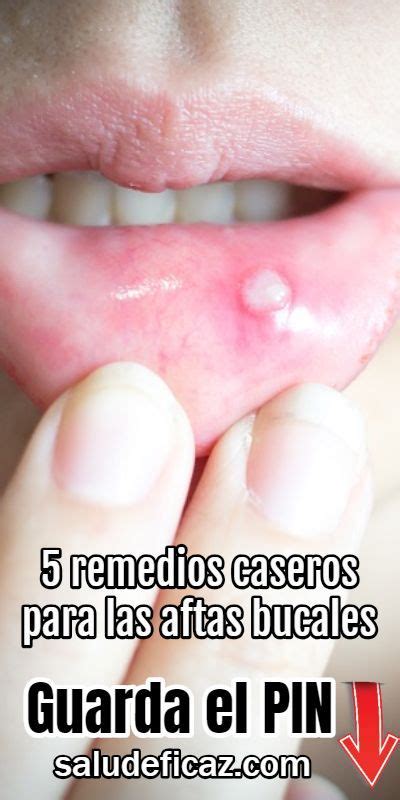 Remedios Caseros Super Efectivos Para Curar Las Aftas Buc Aftas