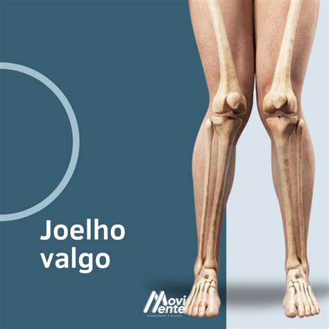 SOBRE O JOELHO VALGO Rede MoviMente Fisioterapia E Pilates