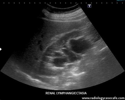 Abdomen Radiology Case Cafe