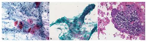 Cytomorphological Findings In A Lymphoepithelial Cyst Of The Pancreas