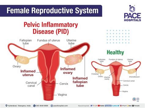Pelvic Inflammatory Disease Diagram