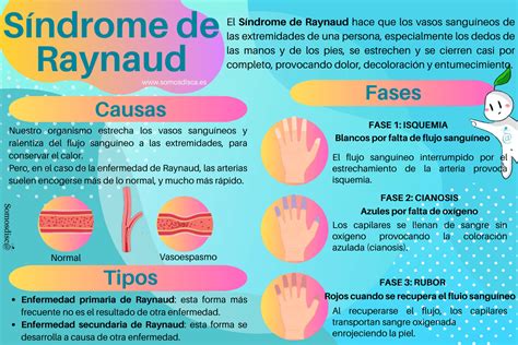 Qu Es El S Ndrome De Raynaud Somosdisc