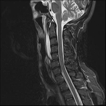 Acute Longus Colli Calcific Tendinitis Image Radiopaedia Org