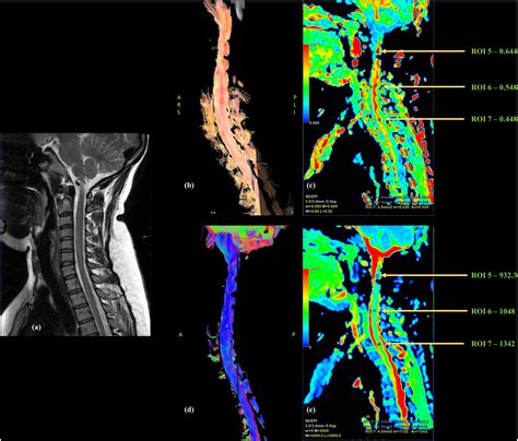 Role Of Diffusion Tensor Imaging And Tractography In Spinal Cord Injury