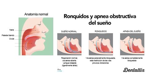 Soluciones Odontol Gicas Para Tus Pacientes Con Apnea Del Sue O Dentaltix