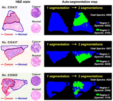 auto segmentation of breast cancer tissue sections these three tissue download scientific