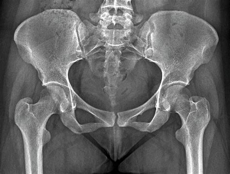 Female Pelvis Bone Structure