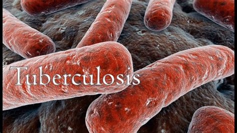 Qué es la tuberculosis Una infección que puede ser mortal si no es