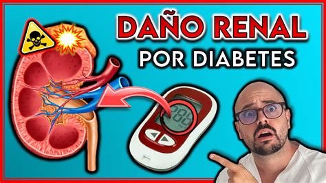 SINTOMAS de RIÑONES ENFERMOS por DIABETES INSUFICIENCIA RENAL por