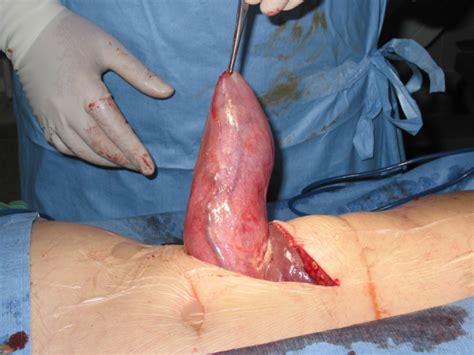 Akute Cholecystitis Gallenblase DocCheck