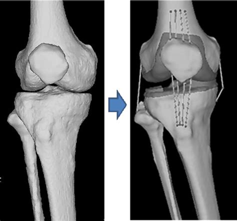 figure 1 from simulating knee stress distribution using a computed tomography based finite