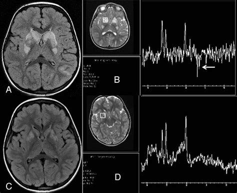 Biotin Responsive Basal Ganglia Disease Neuroimaging Features Before