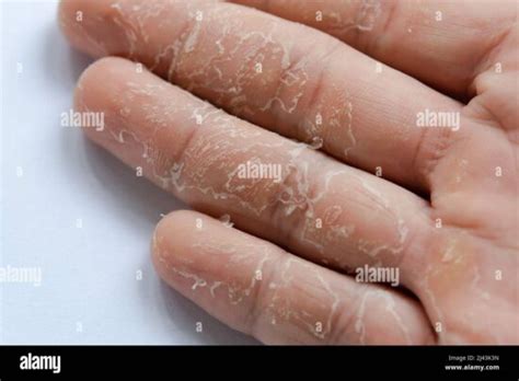 8 razones por las que se pelan las yemas de los dedos y cómo