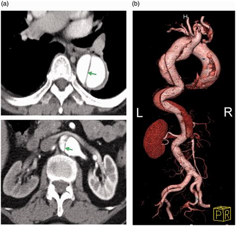 Iatrogenic Aortic Dissection Following Transradial Coronary Angiography