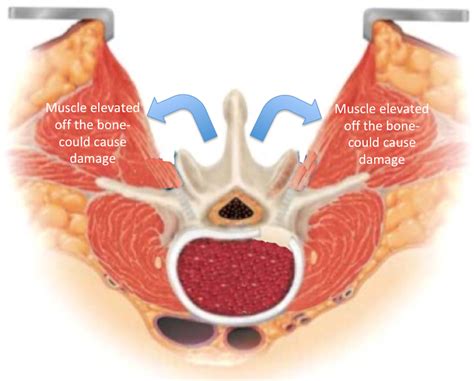 Open Spine Surgery