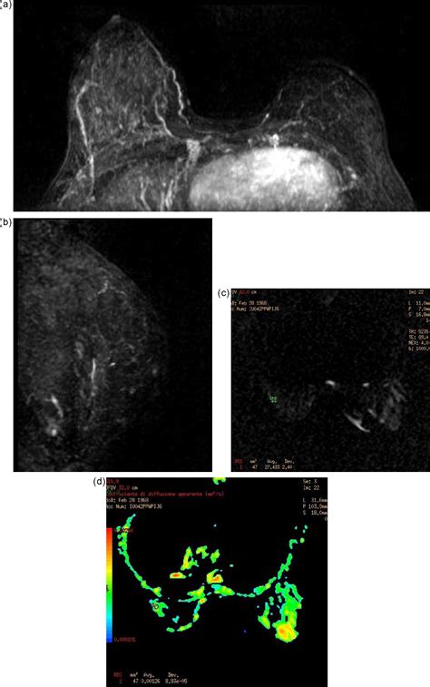 dwi in breast mri role of adc value to determine diagnosis between recurrent tumor and surgical