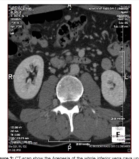 Figure 2 From Inferior Vena Cava Agenesia And Its Association With