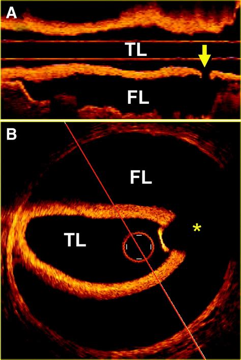 Spontaneous Coronary Artery Dissection Circulation
