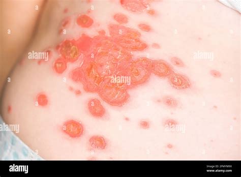 La pyyriasis rosea est un type de dermatite avec une légère éruption