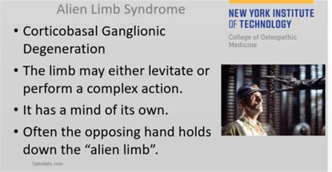 Lecture Unusual Neurological Diseases Somatoform Disorders And