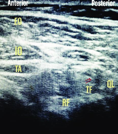 Tip Of Needle Between Transversalis Fascia And Quadratus Lumborum