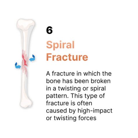 7 Types Of Bone Fractures Orthopaedic Surgeon Durban