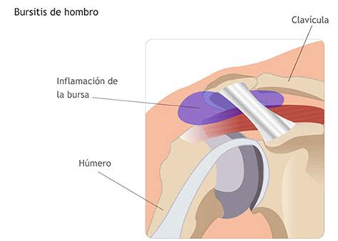 Dr Diego Albertengo Síndrome de Fricción Subacromial y Lesiones del