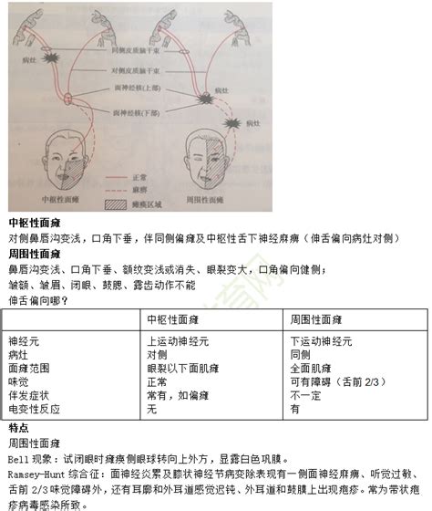2020年临床助理医师考点中枢性面瘫与周围性面瘫