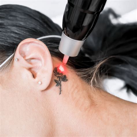 Eliminacion De Tatuajes KIREI
