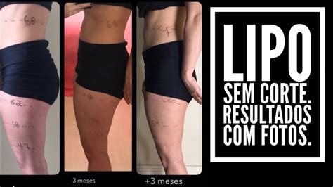 Lipo sem corte minha experiência fotos YouTube