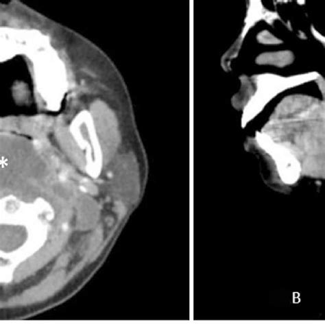 A And B Are Contrasted CT Scan Of Neck With Axial And Sagittal View