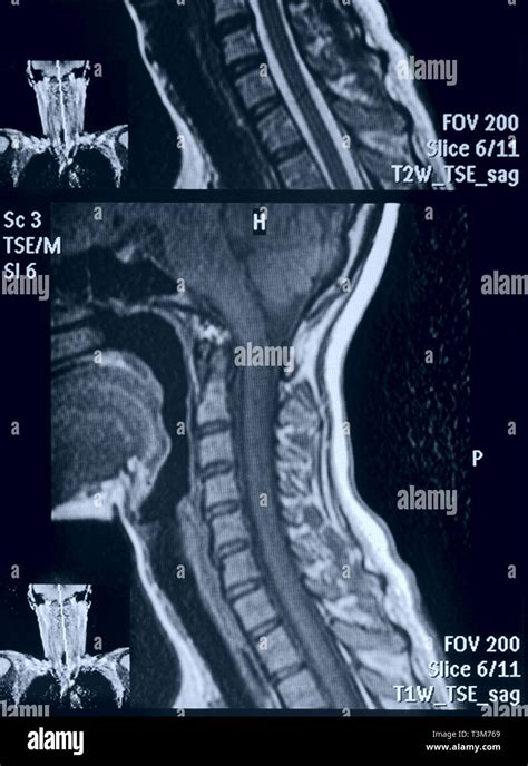Mri Neck Hi Res Stock Photography And Images Alamy