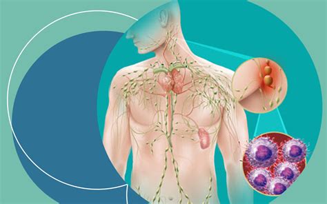 Linfoma Dikysa Equipos y reactivos de laboratorio clínico