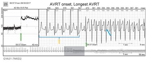 Atrioventricular Nodal Reentrant Tachycardia AVNRT 41 OFF