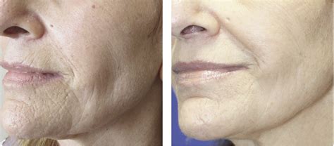 Antes Y Despues Secretrf Radiofrecuencia Fraccionada Microagujas