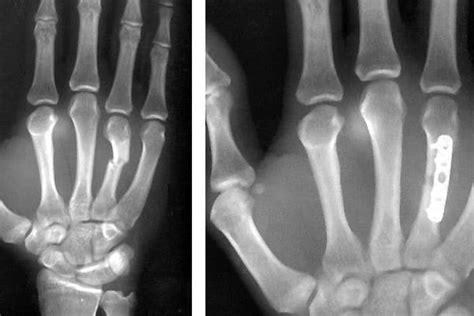 Qué hacer con una fractura de dedo Consejos e indicaciones