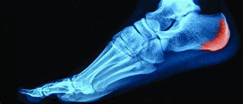 Espolón calcáneo Causas síntomas tratamiento y prevención Blog